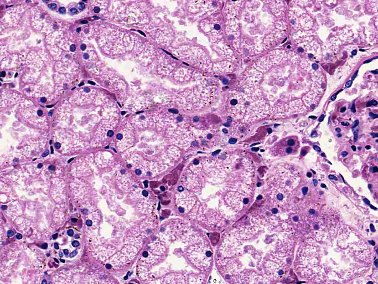 肾小管上皮细胞水肿-肾小管上皮细胞水肿-Pathology Images Database
