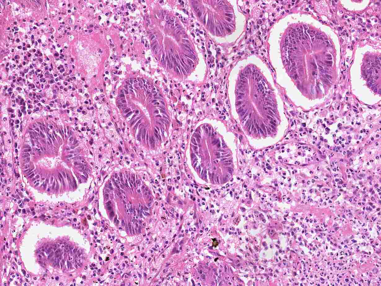 急性蜂窝织性阑尾炎-急性蜂窝织性阑尾炎-Pathology Images Database