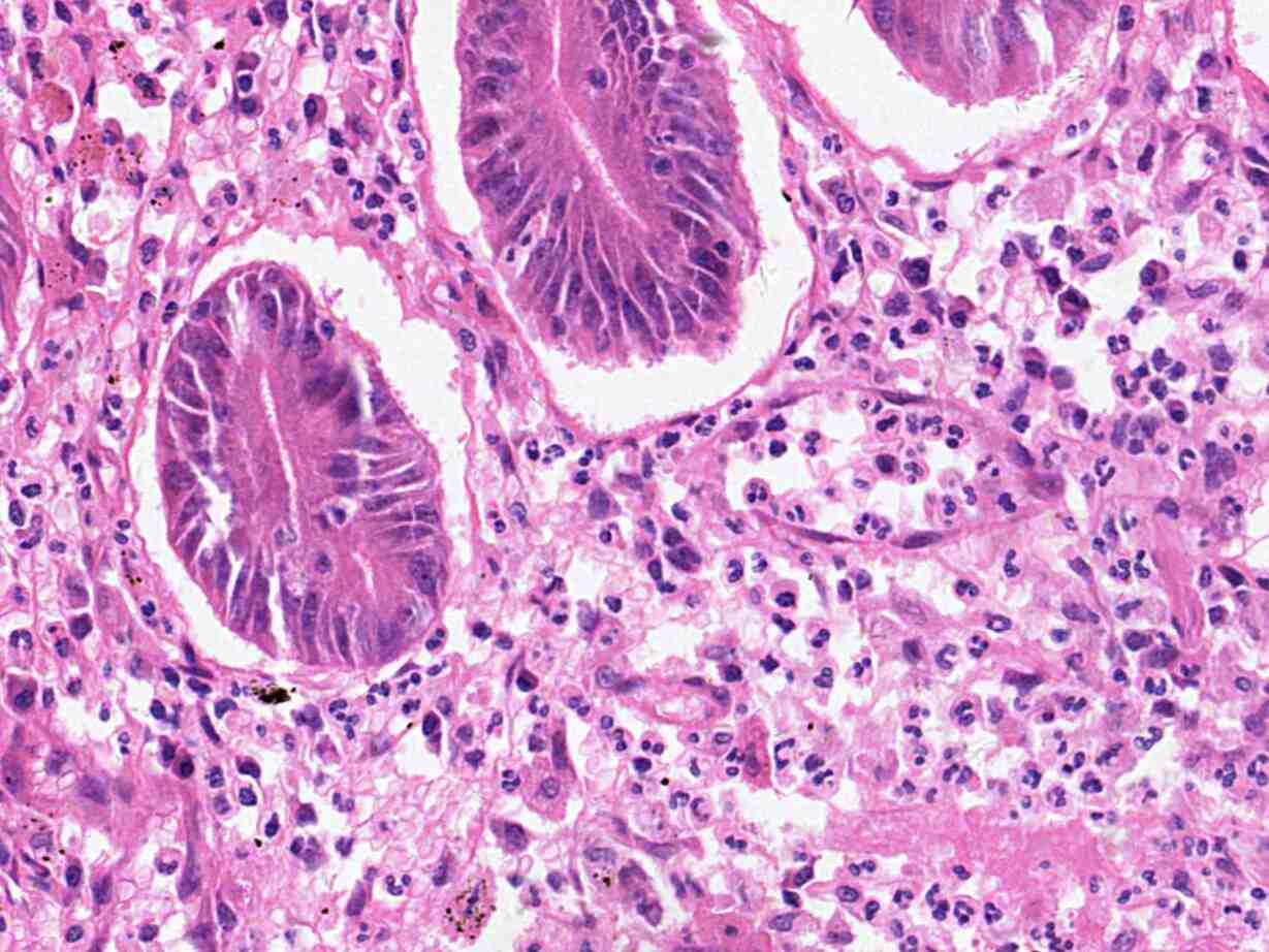 急性蜂窝织性阑尾炎-急性蜂窝织性阑尾炎-Pathology Images Database