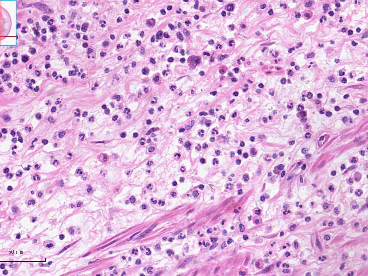 急性蜂窝织性阑尾炎-急性蜂窝织性阑尾炎-Pathology Images Database