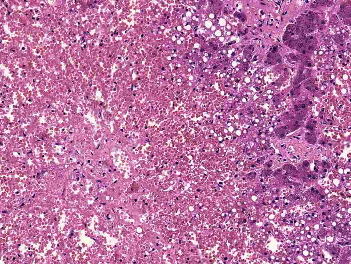 肝淤血-肝淤血-Pathology Images Database