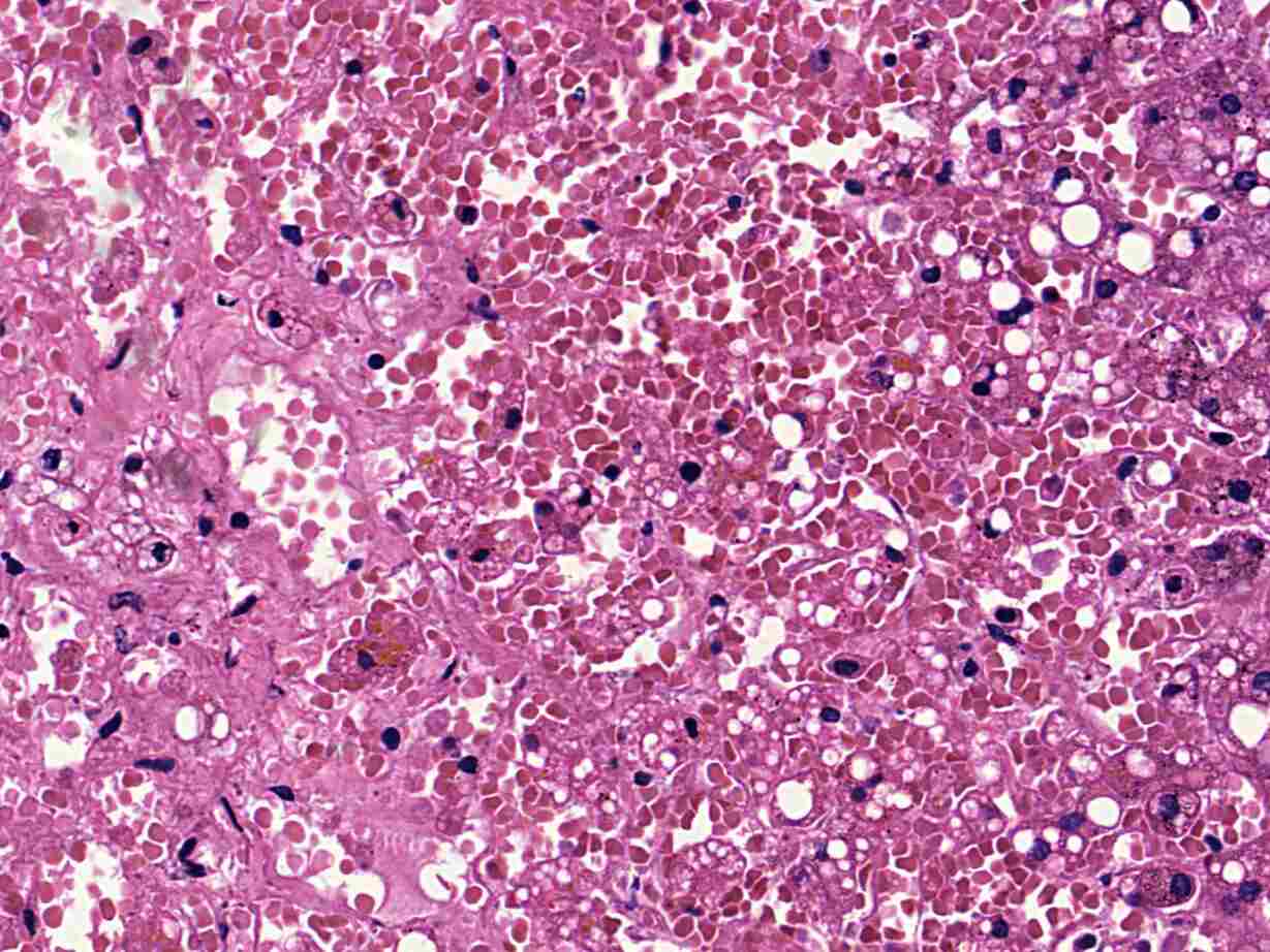 肝淤血-肝淤血-Pathology Images Database