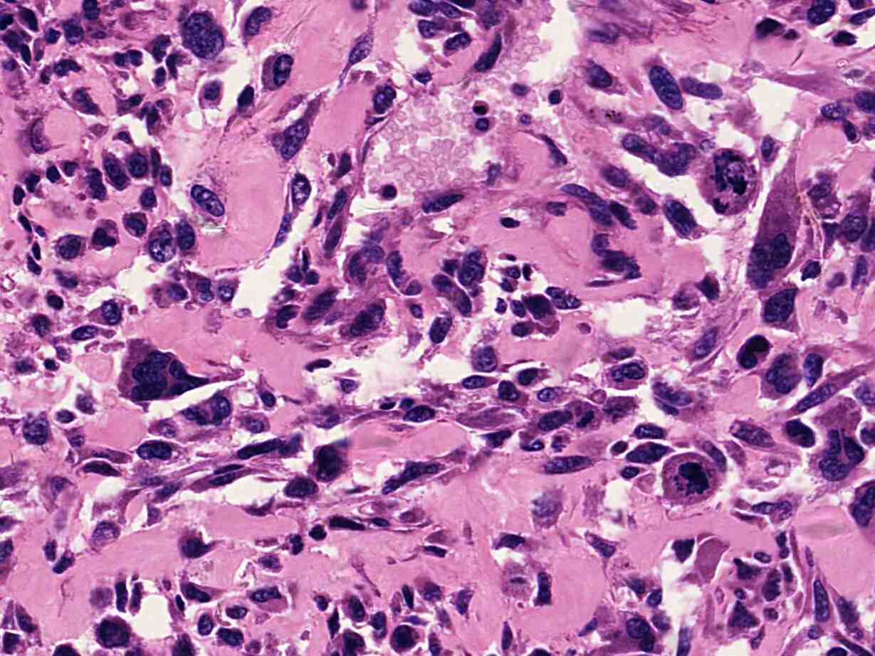 骨肉瘤-骨肉瘤-Pathology Images Database