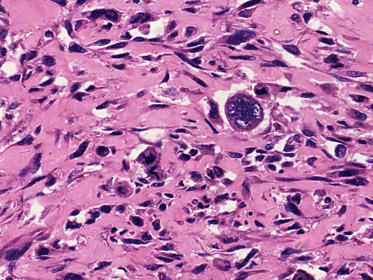骨肉瘤-骨肉瘤-Pathology Images Database