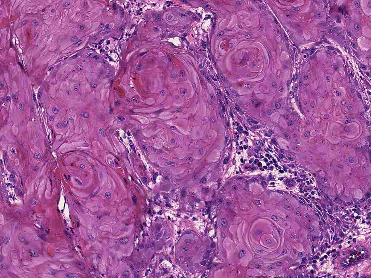 鳞状细胞癌-鳞状细胞癌-Pathology Images Database