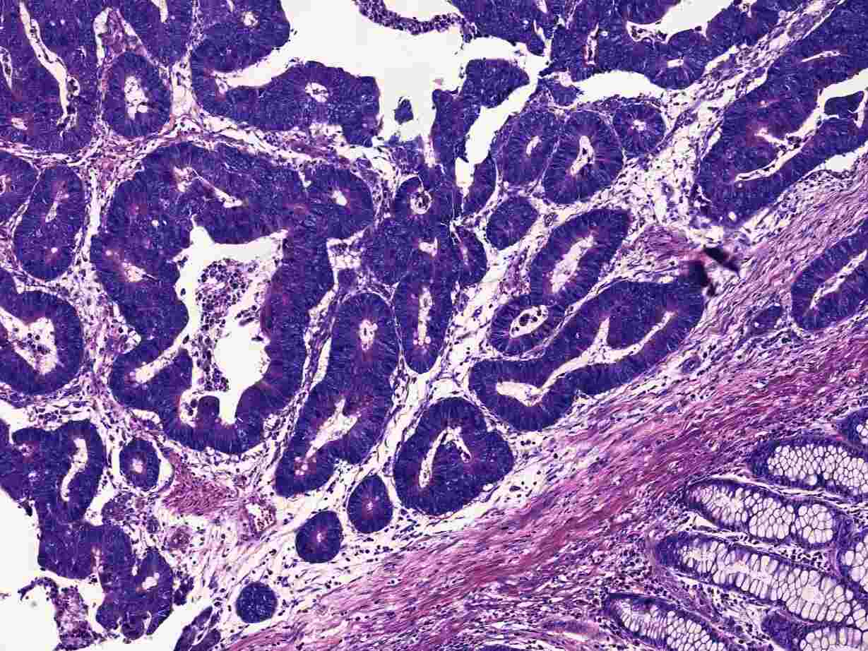 结肠腺癌-结肠腺癌-Pathology Images Database