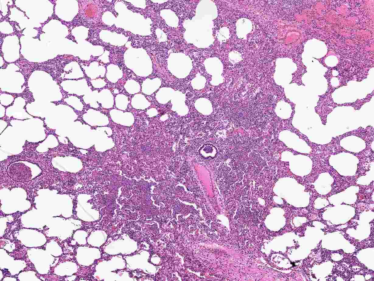 小叶性肺炎-小叶性肺炎-Pathology Images Database