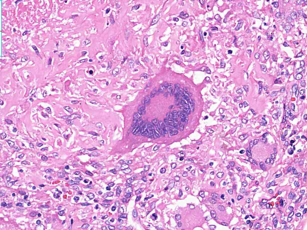 Langhangs巨细胞-朗格汉斯巨细胞-Pathology Images Database