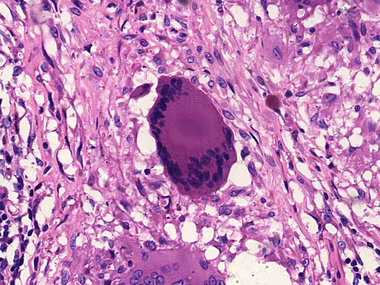 Langhangs巨细胞-朗格汉斯巨细胞-Pathology Images Database